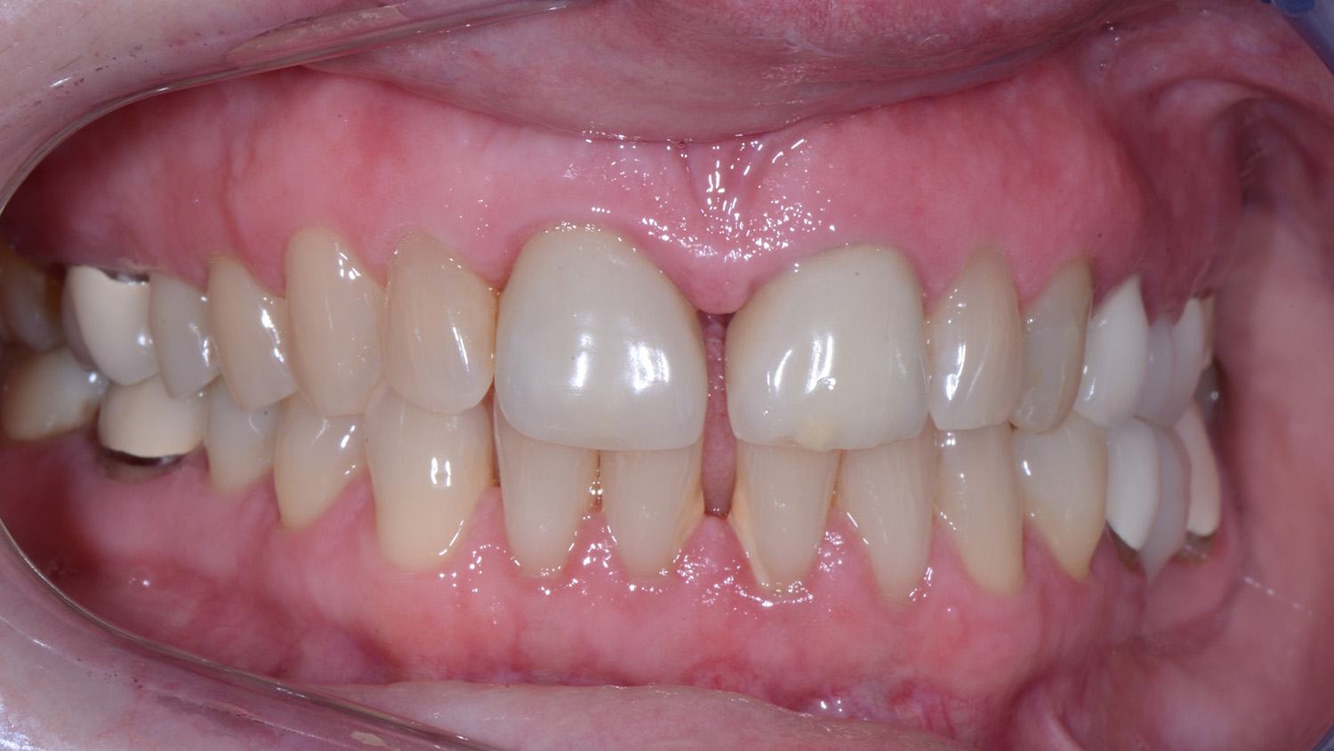 Treatment Options To Close A Gap Between The Front Teeth